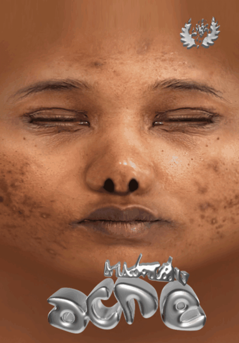 22+ Best Sims 4 Acne CC and Mods: Realistic Overlays, Breakouts, and ...